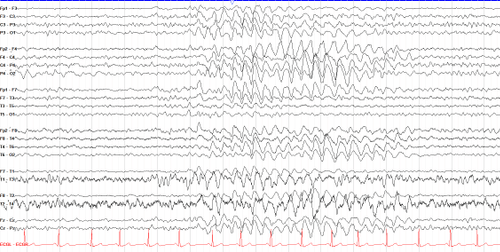 Slowing and other Non-Epileptiform Abnormalities