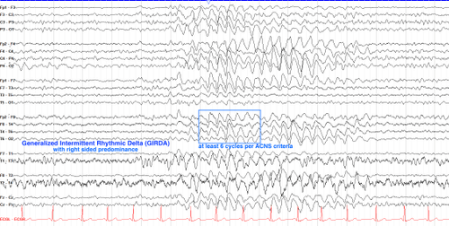 Slowing and other Non-Epileptiform Abnormalities