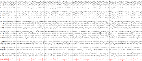Slowing and other Non-Epileptiform Abnormalities