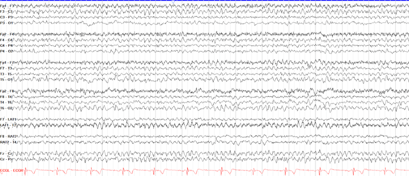 Slowing and other Non-Epileptiform Abnormalities