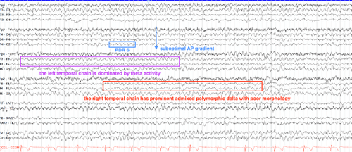Slowing and other Non-Epileptiform Abnormalities