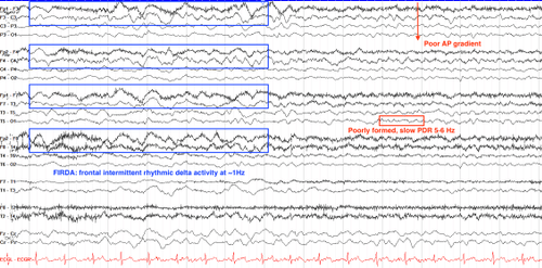 Slowing and other Non-Epileptiform Abnormalities