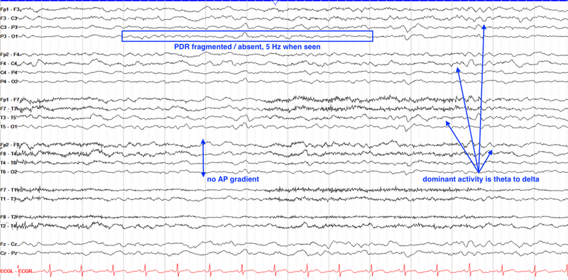 Slowing and other Non-Epileptiform Abnormalities
