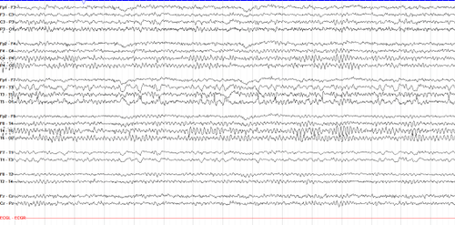 Slowing and other Non-Epileptiform Abnormalities