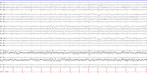 Slowing and other Non-Epileptiform Abnormalities