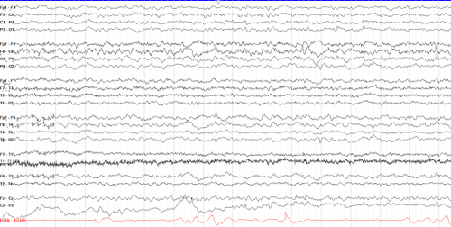 Slowing and other Non-Epileptiform Abnormalities