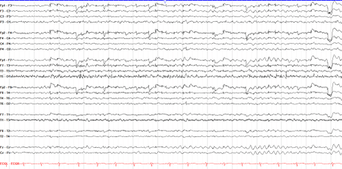 Slowing and other Non-Epileptiform Abnormalities