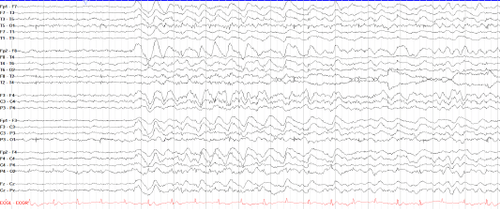 Slowing and other Non-Epileptiform Abnormalities