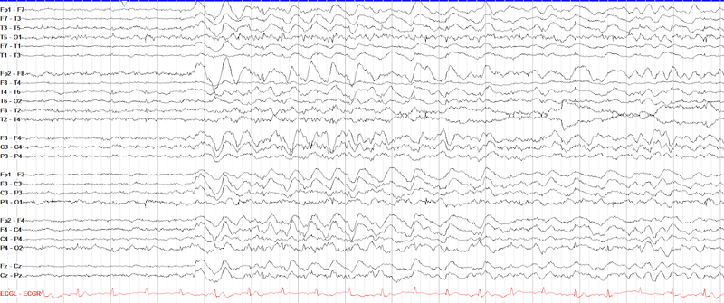 Slowing and other Non-Epileptiform Abnormalities