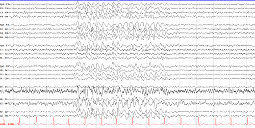 Slowing and other Non-Epileptiform Abnormalities