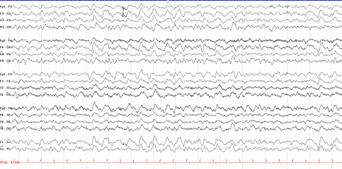 Slowing and other Non-Epileptiform Abnormalities