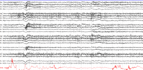 Slowing and other Non-Epileptiform Abnormalities