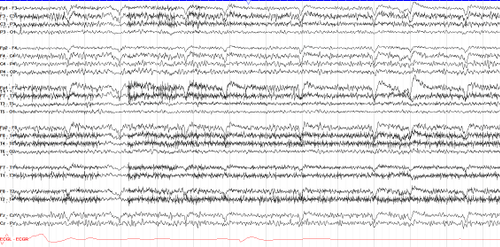 Slowing and other Non-Epileptiform Abnormalities