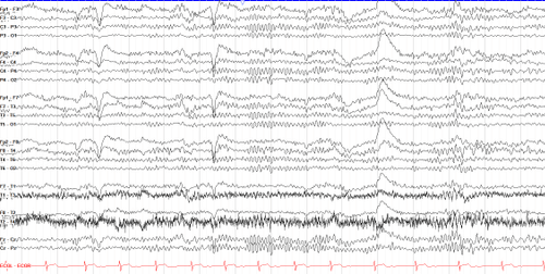 The Normal Awake EEG