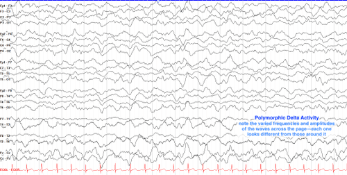 EEG Terminology and Waveforms