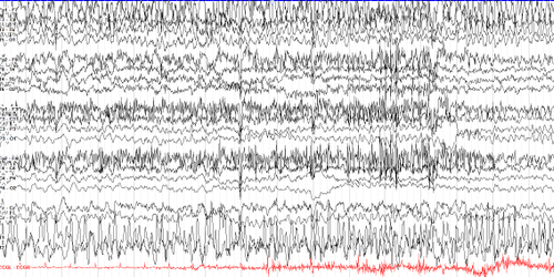 Seizures