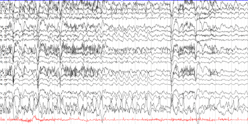Seizures