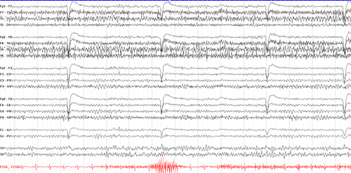The Normal Awake EEG