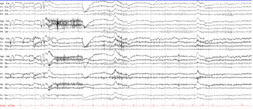 The Normal Awake EEG