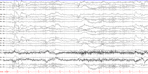 The Normal Awake EEG