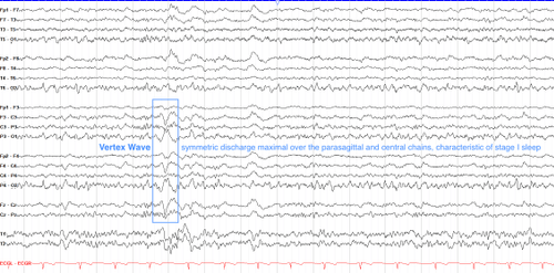 The Normal Asleep EEG