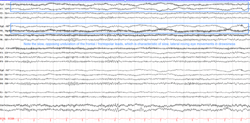 The Normal Asleep EEG
