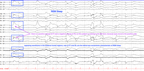 The Normal Asleep EEG
