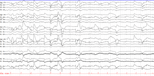 The Normal Asleep EEG