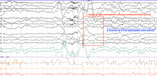 The Neonatal EEG