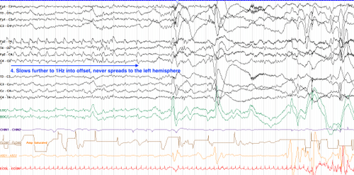 The Neonatal EEG