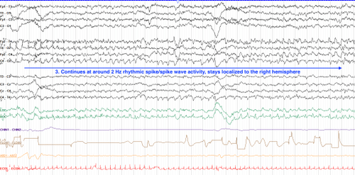 The Neonatal EEG