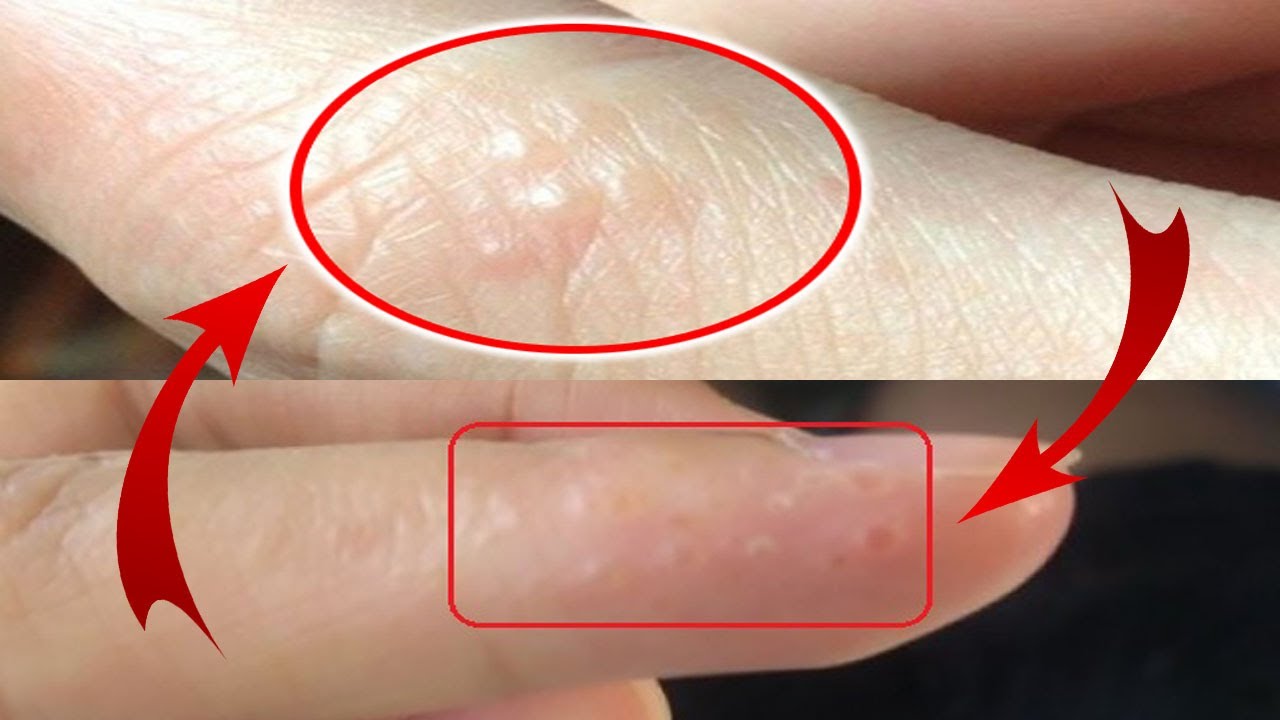 Tại Sao Bị Nổi Mụn Nước ở Ngón Chân Và Cách Trị An Toàn Tại Nhà Blog