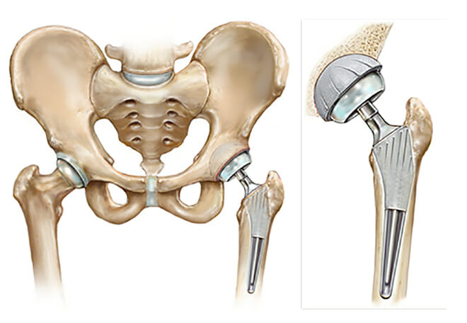 Total Hip Replacement or Arthroplasty