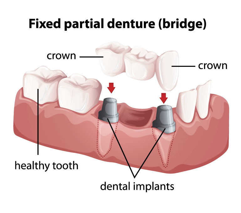Dental Implants Baltimore - Honeygo Village Dental Implants