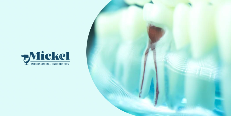 Mickel Microsurgical Endodontics | Endodontic & Root Canal Specialist ...