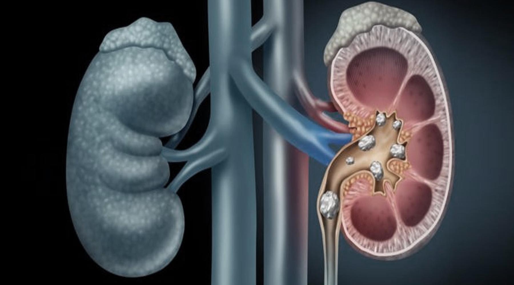 Cálculos renales | Dr. Jairo Domínguez
