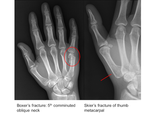 Metacarpal fractures
