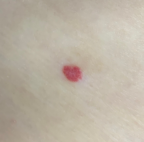 Angioma | Spot Check: skin cancer + aesthetics. Melbourne CBD