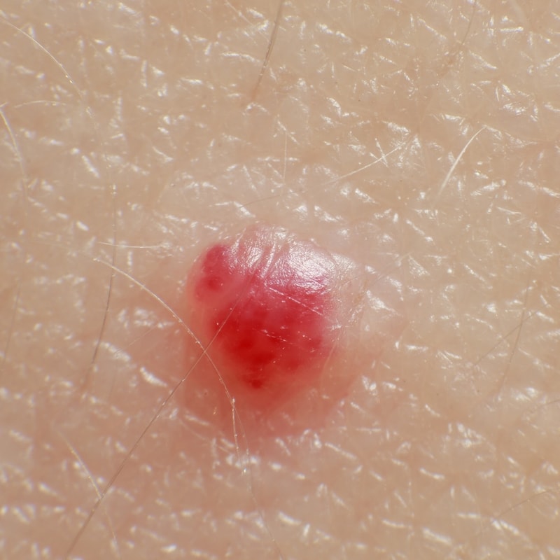 Skin cancers and conditions | Spot Check: skin cancer + aesthetics ...