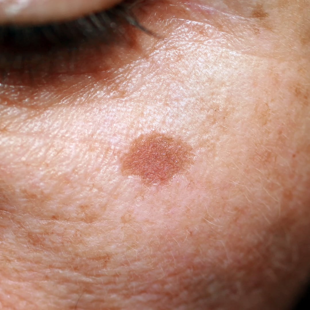 Skin cancers and conditions | Spot Check: skin cancer + aesthetics ...