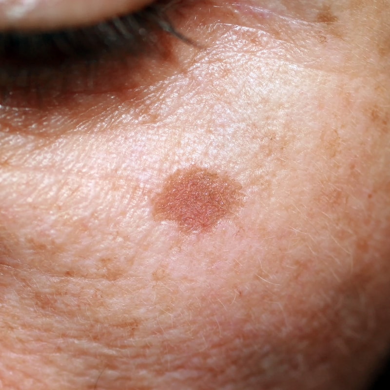 Skin cancers and conditions | Spot Check: skin cancer + aesthetics ...