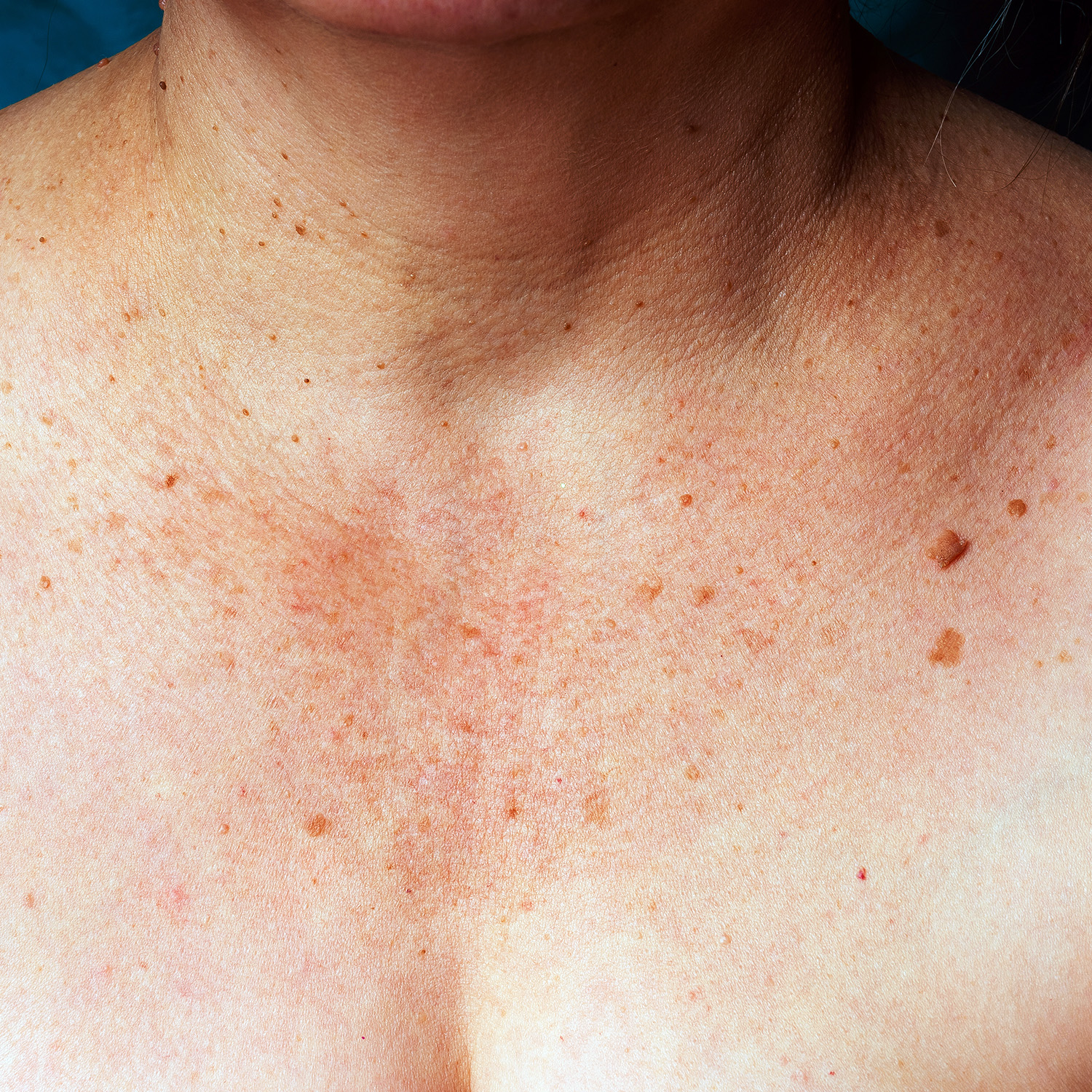 Sun Damaged Skin On Chest Sun Damaged Skin On Chest