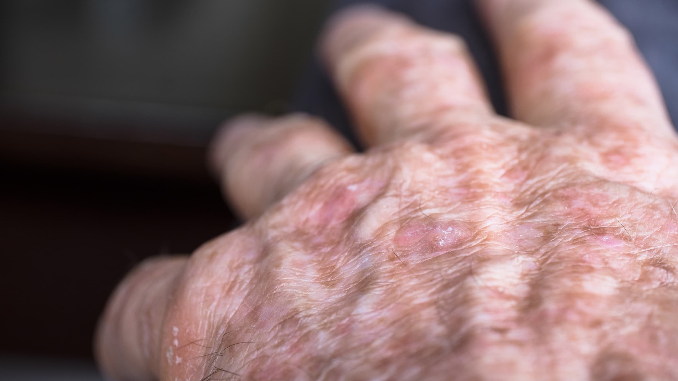 Solar keratoses | Spot Check Clinic