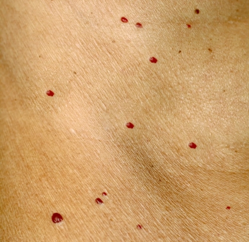 Angioma | Spot Check: skin cancer + aesthetics. Melbourne CBD