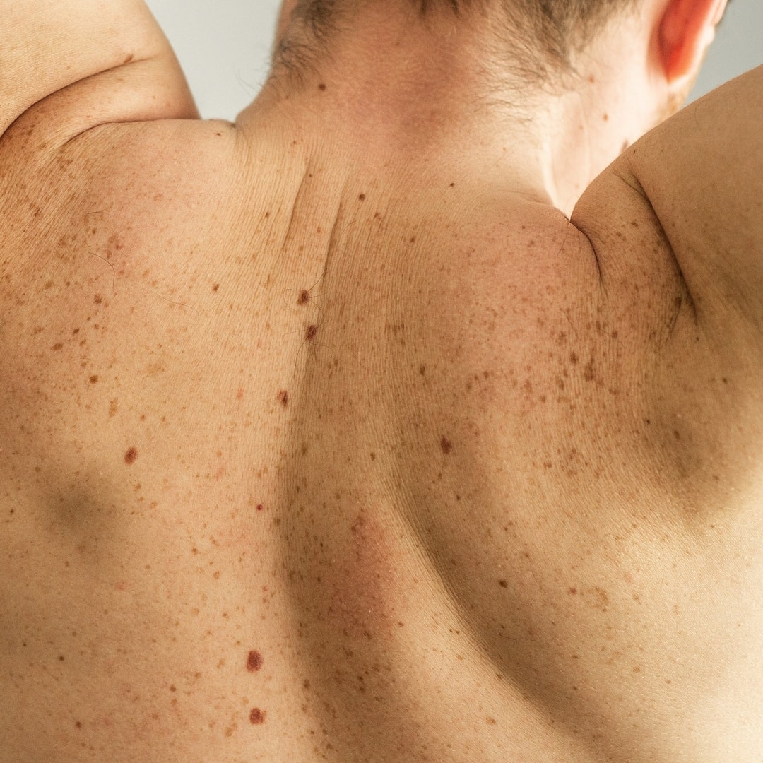 Spot Check Clinic: Skin cancer and skin health clinic, Melbourne CBD.