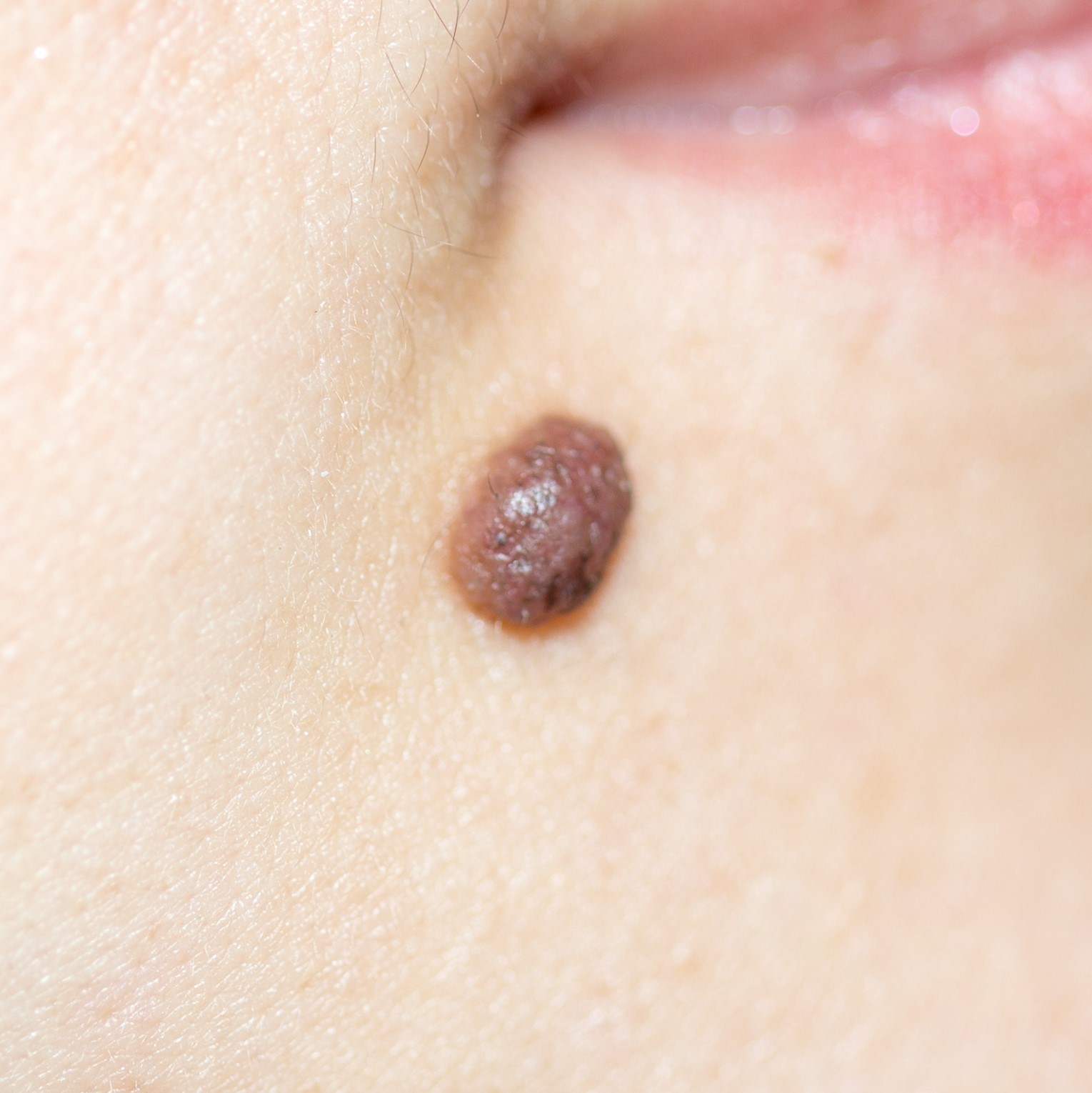 Understanding The Different Types Of Moles Spot Check Clinic 2022 