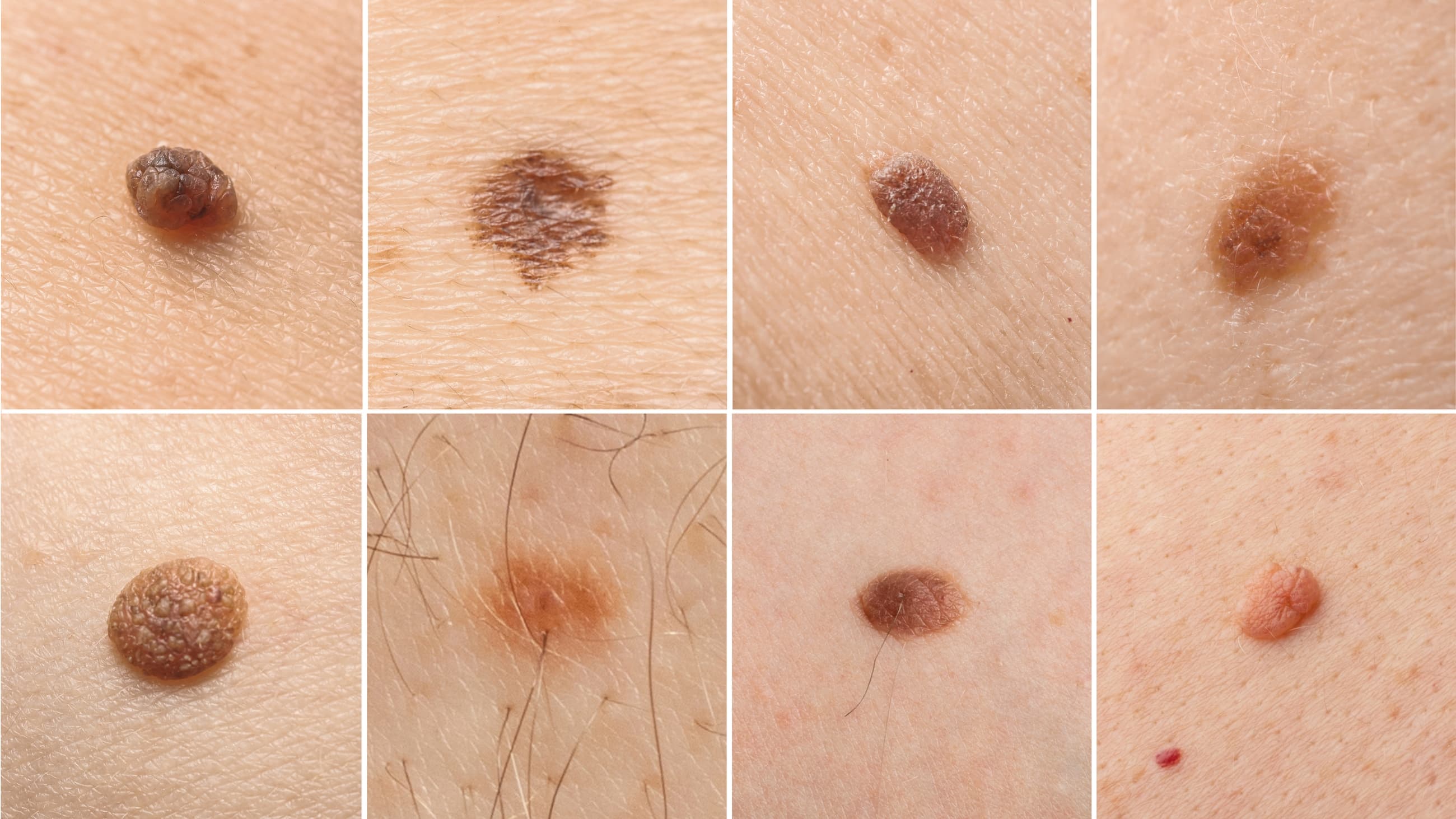 Understanding The Different Types Of Moles Spot Check Clinic Understanding The Different Types Of Moles Spot Check Clinic