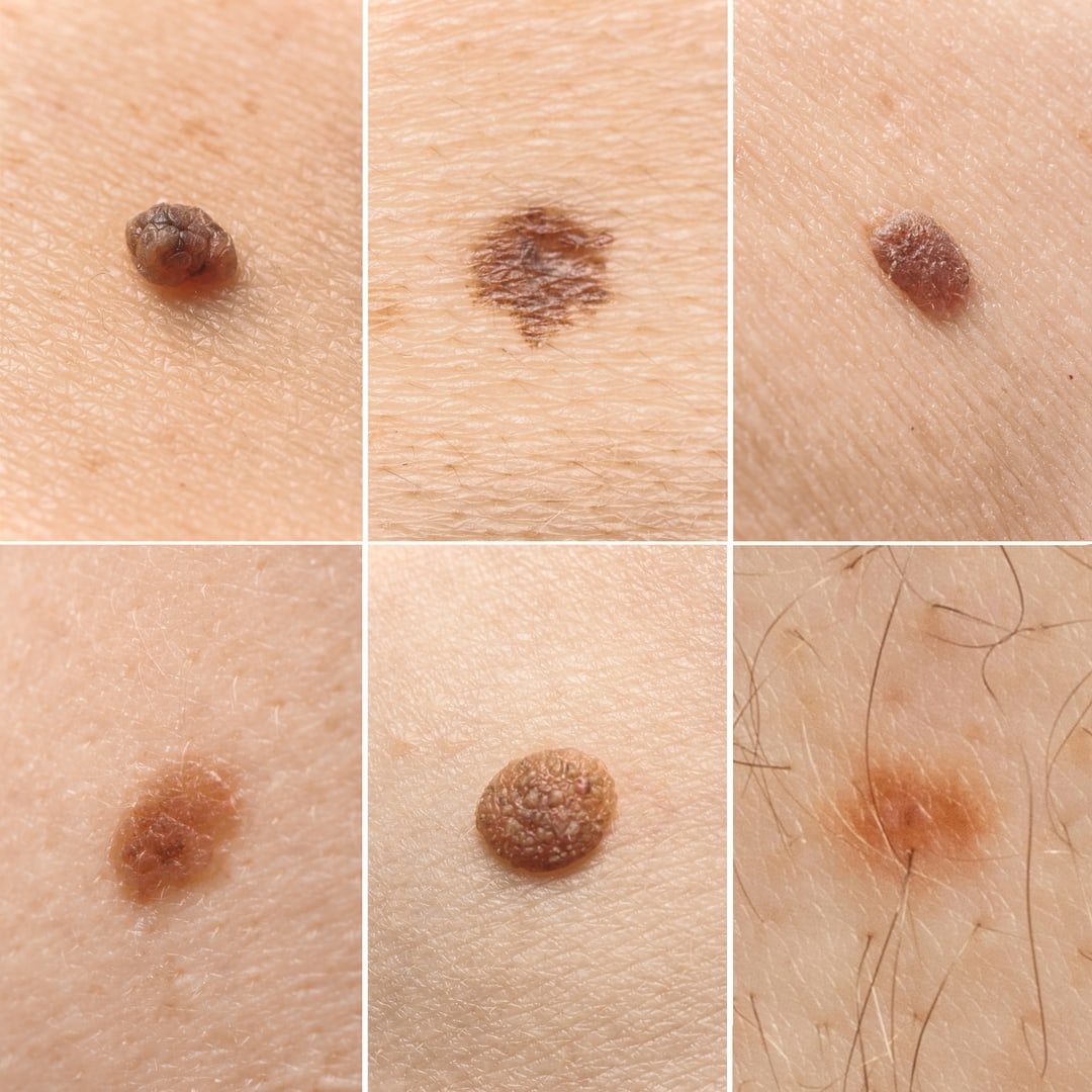 Compound naevus (mole) | Spot Check: skin cancer + aesthetics ...