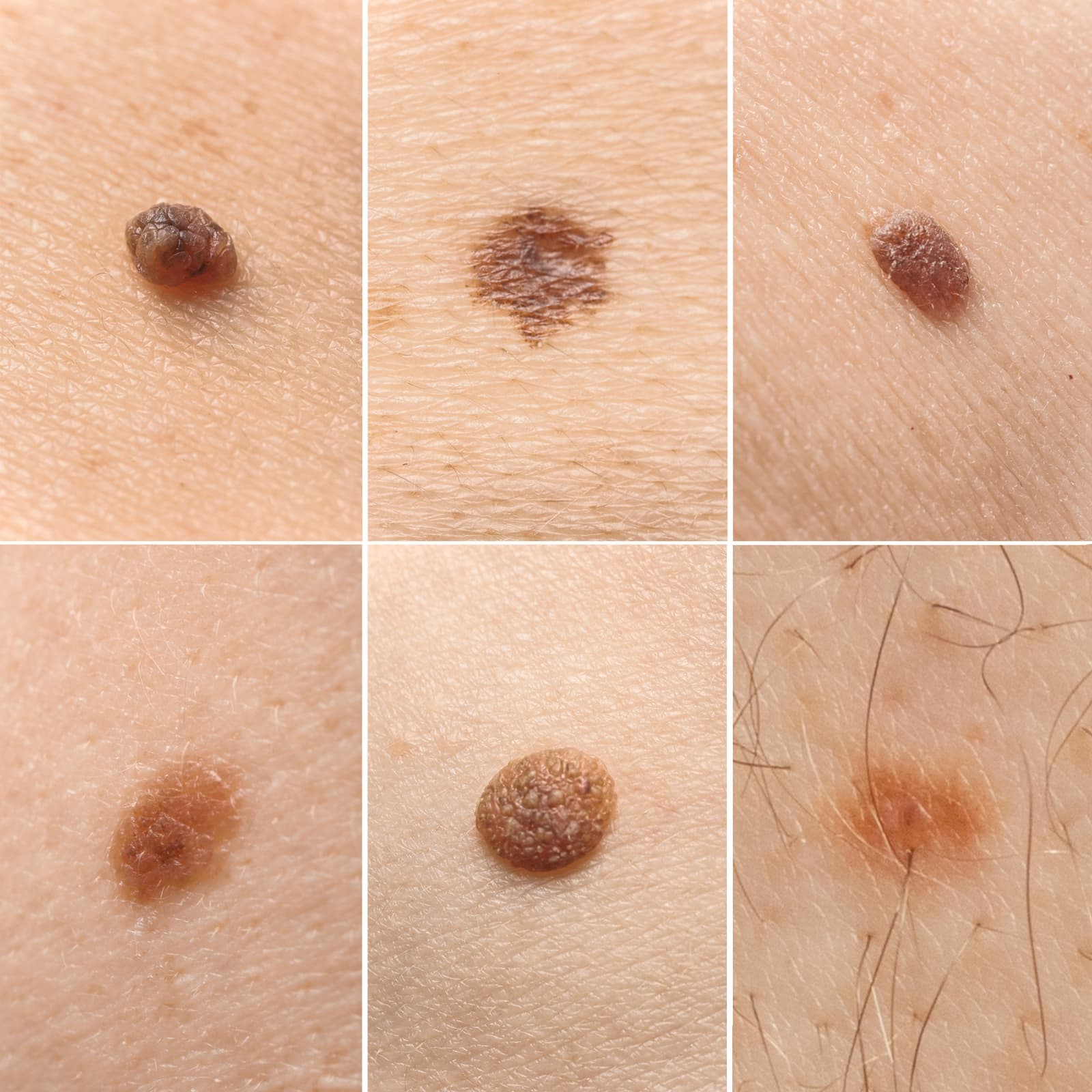 Dermal naevus (mole) | Spot Check: skin cancer + aesthetics. Melbourne CBD