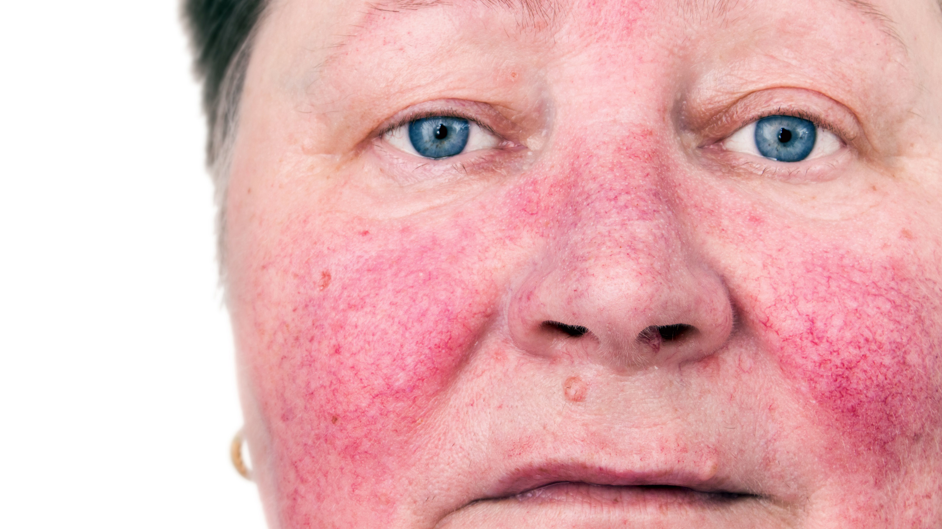 Treating Rosacea On The Face Spot Check Skin Cancer Aesthetics Treating Rosacea On The Face Spot Check Skin Cancer Aesthetics